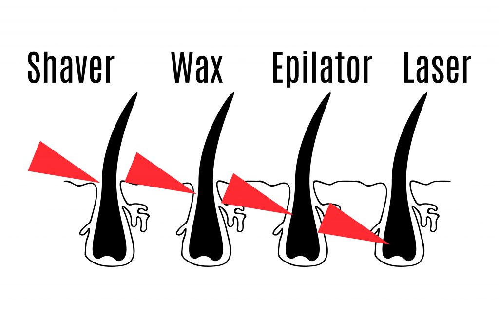 The Pros and Cons of Hair Removal Methods Colorado Laser Spa Wellness Clinic